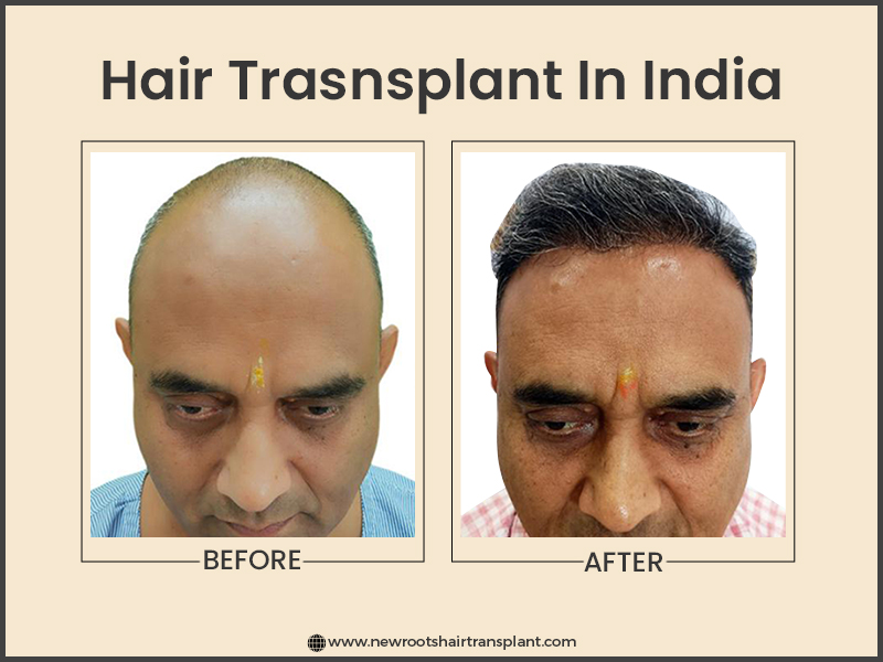 Hair Transplant Cost In India Get The Best Price For 2023